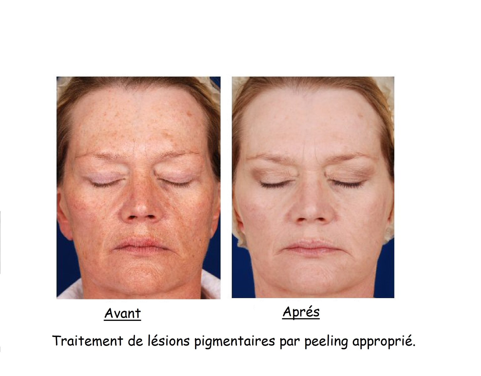 Dermatologie esthétique castres | Peeling