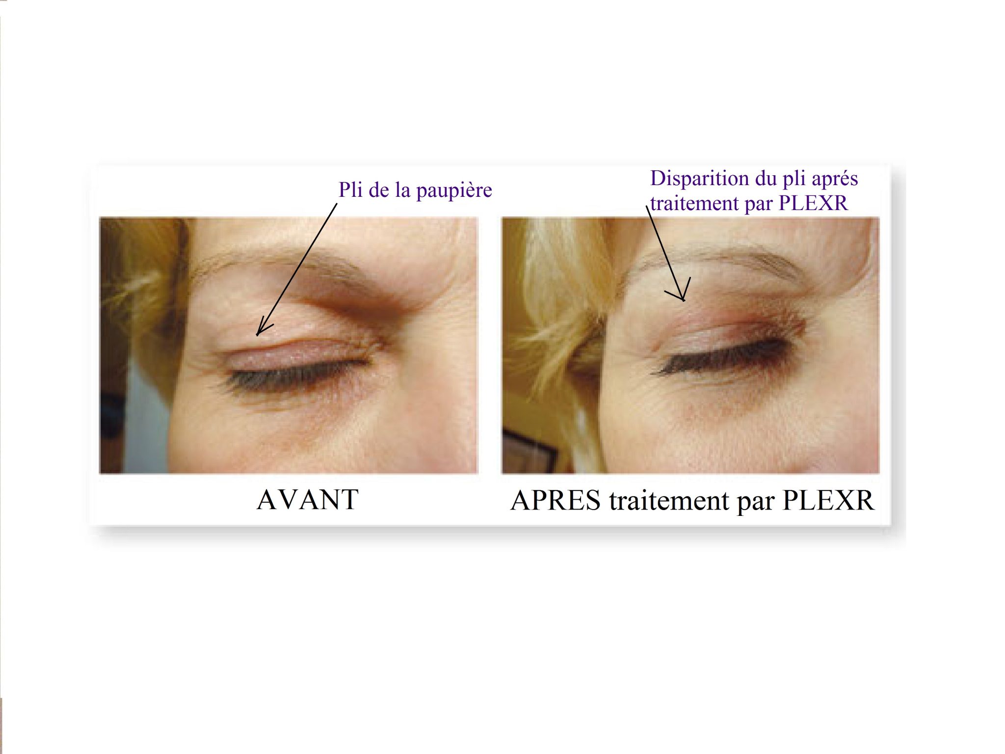 Dermatologie esthétique castres | Blépharoplastie – Paupières Dermatologie esthétique castres | Blépharoplastie – Paupières